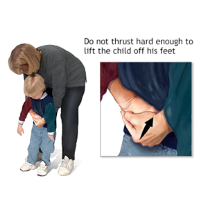 How to Effectively Use First Aid and the Heimlich Maneuver to Stop ...