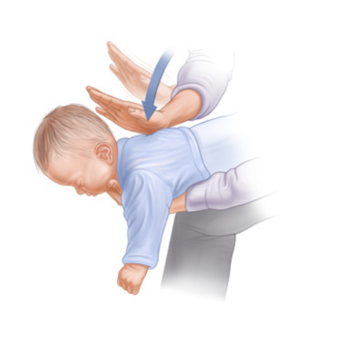 Choking First Aid: How to Save an Infant Under 1 Year from Choking ...