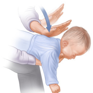 Choking Hazards in Infants and Children: AAP Prevention and First Aid ...