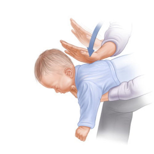 Choking First Aid: Essential Steps for Infant Choking Emergencies ...