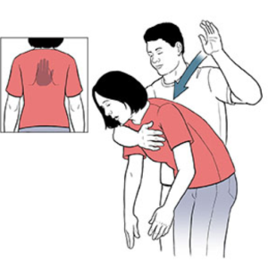 How to Save Someone from Choking: Heimlich Maneuver and First Aid ...