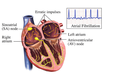 Atrial Fibrillation vs Ventricular Fibrillation: Key Differences - Willnice