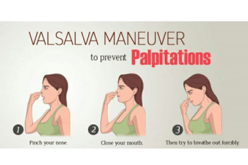 Vagal Maneuvers: Valsalva Maneuver for Supraventricular Tachycardia ...