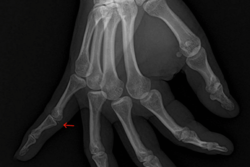 Avulsion Injuries: Skin Avulsion, Wounds, and Treatment - Willnice