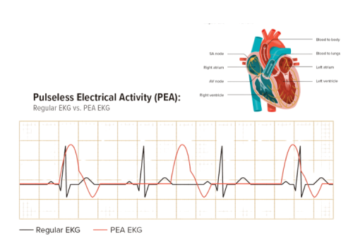 Pulseless Electrical Activity: Cardiac Arrest and Resuscitation - Willnice