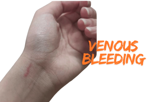 Venous vs Arterial Bleeding: Type of Bleeding & First Aid - Willnice